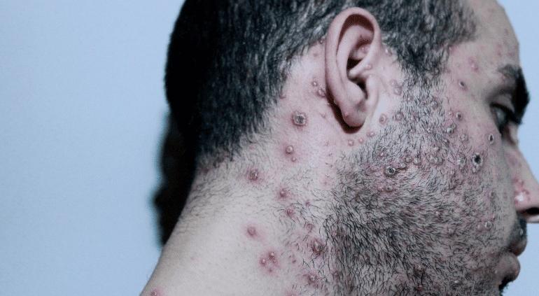 Desacelera México en casos de viruela símica un 30% | Tiempo