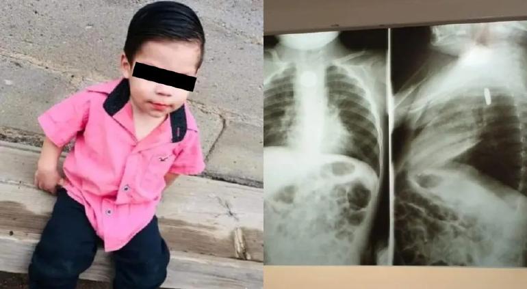 Bebé tragó una pila por accidente, le provocó daños en el esófago