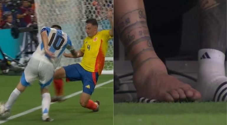 ¡Terrible! Así quedó tobillo de Messi tras lesión en la Copa América