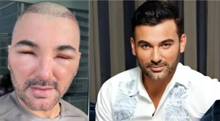 ¿Qué le pasó? Reapareció actor de Televisa con el rostro desfigurado