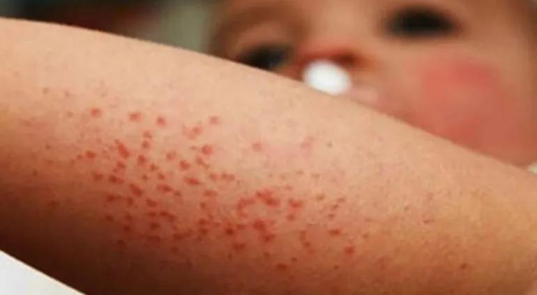 18 casos de sarampión en Chihuahua, el estado con más contagios: SSa